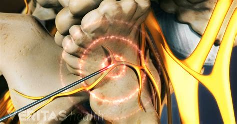 Potential Complications Of Radiofrequency Neurotomy
