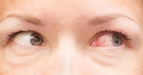 How Long Does Pink Eye Last Symptoms Treatment And Prevention