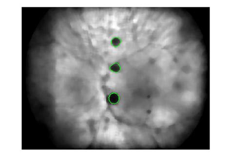 Multiple Detection Of Three Retinal Lesions After Iterations In The Download Scientific