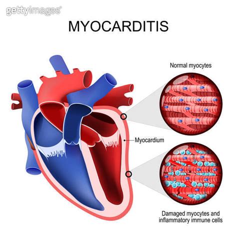 Myocarditis Inflammatory Cardiomyopathy Cross Section Of A Human