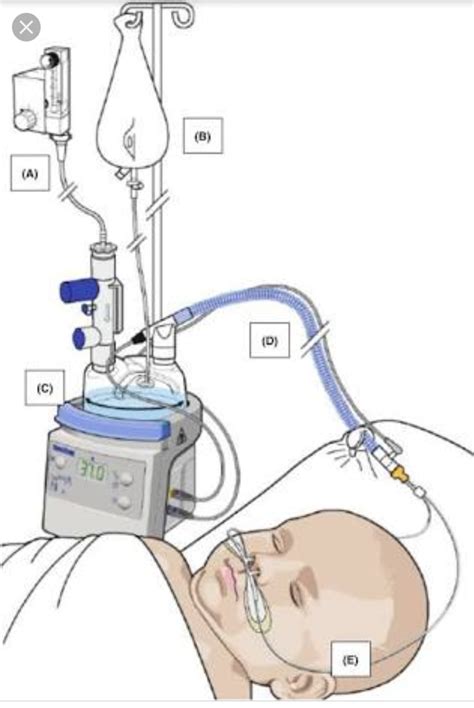 Hfnc Is An Effective Mode Of Indian Pediatrics Facebook