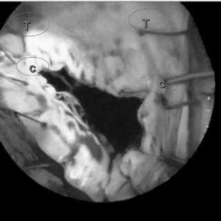 Lead ECG Shows Atrial Flutter With Flutter Waves Morphology Positive Download Scientific