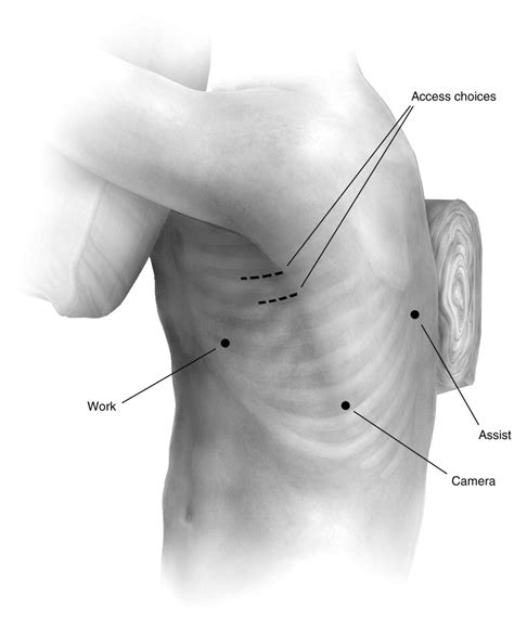 Video Assisted Thoracic Surgery Lobectomy Operative Techniques In