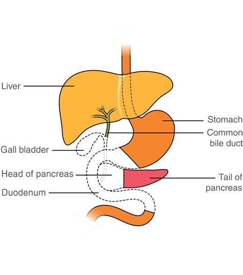 Whipple Procedure Diagram