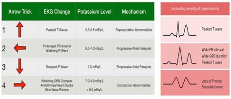 Severe Hyperkalemia Ecg