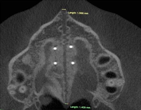 Intermaxillary Suture Radiograph
