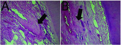 The Arrow Points To Pulp Calcifications A Photomicrograph Of Dental