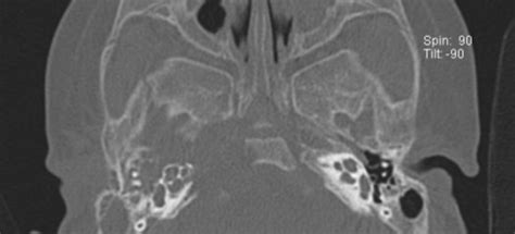 Computed Tomography Of The Temporal Bone An Expansile Osteolytic Bone