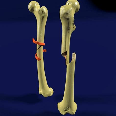 Stl File Spiral Fracture Skeleton Labelled Femur 3d Model・3d Print Model To Download・cults