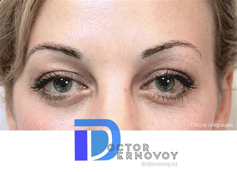 Блефаропластика верхних и нижних век — Пластический хирург Сергей Дерновой консультация в Москве
