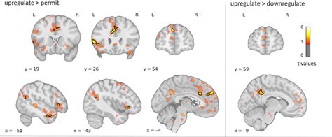 Whole‐brain Activations For Controls Patients Black Contours