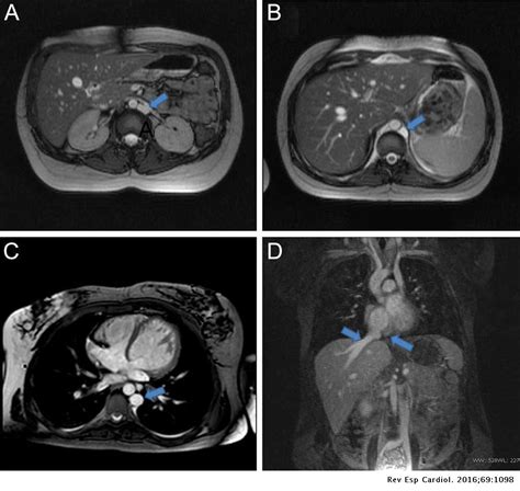 Isolated Anomaly Of The Systemic Venous Return Revista Española De Cardiología