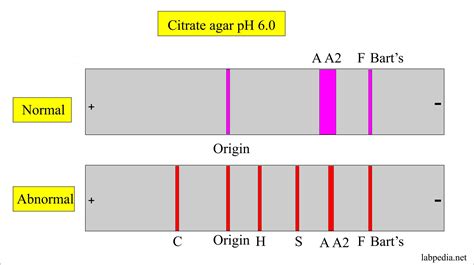 Hemoglobin Part 2 Hemoglobin Electrophoresis Hb Electrophoresis