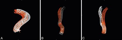 Figure 4 From Device On Aneurysm Occlusion Rate And Recoil Of The Pipeline Embolization Effect