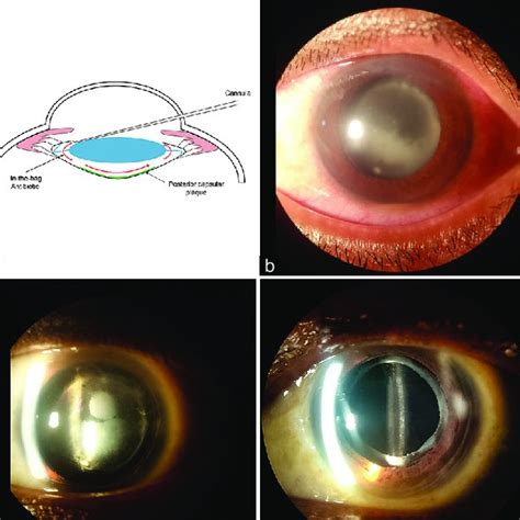 Postoperative Aspect Of The Iris Transillumination Defect Download Scientific Diagram