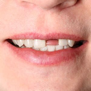 Replacing A Missing Tooth Isn T Just About Improving Your Smile