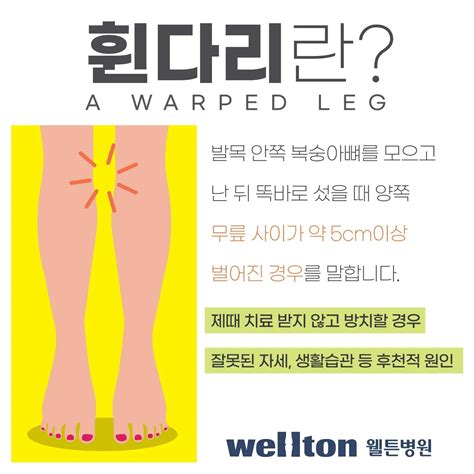 웰튼병원 O자 모양의 휜다리를 가진 분들 중 특히 여성들의 경우 컴플렉스로 인해 치마를 입기가 Facebook