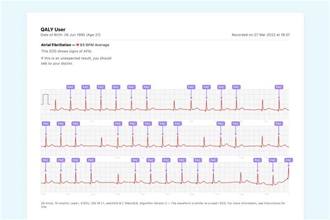 Ectopic Atrial Rhythm