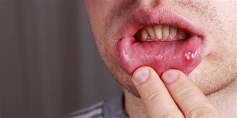 Bác Sĩ Cảnh Báo Những Bệnh Có Thể Lây Khi Quan Hệ Tình Dục Bằng Miệng