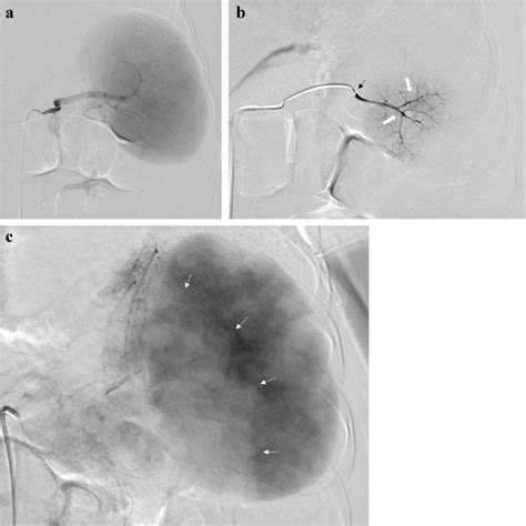 Partial Splenic Embolization In A 7 Year Old Girl With Portal Download Scientific Diagram