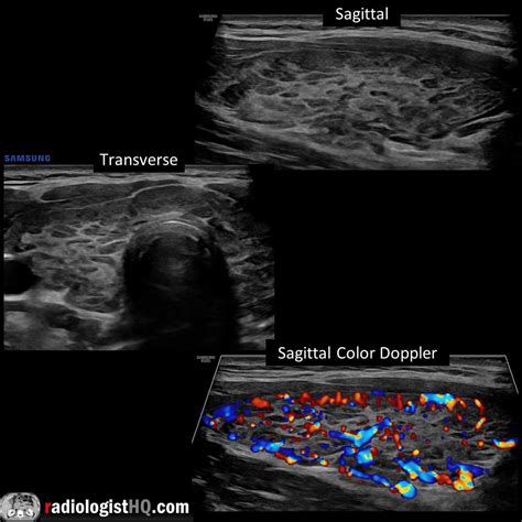 Pseudonodular Appearance Of Hashimotos Thyroiditis On Ultrasound R Radiology