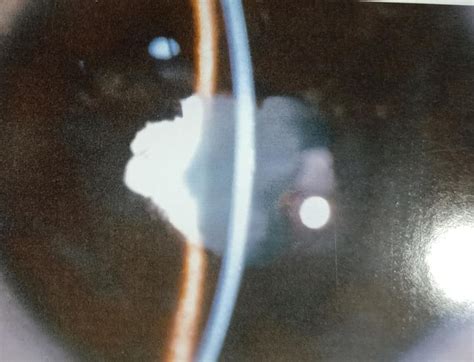 Eye Surgery Case Bhopal 40 Yr Lady With Chronic Uveitis Complicated