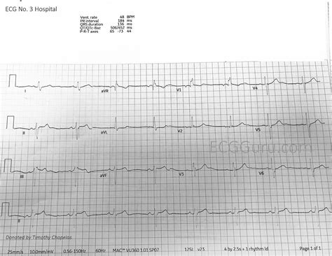 Inferior Myocardial Infarction Ecg