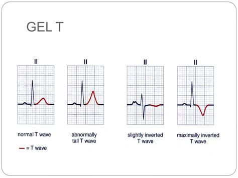 Ekg Dasar Dan Cara Interpretasipptx