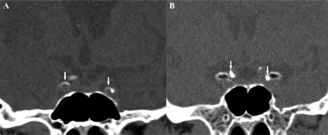 Examples Of Patients With Predominantly Medial A And Intimal B