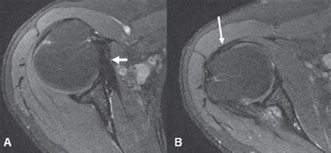 Exaggerated Internal Rotation On The Image A Simulating Subscapularis