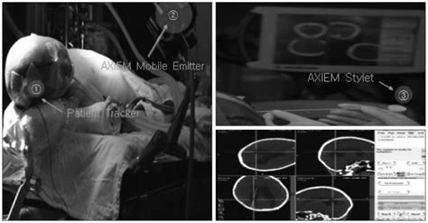 The Operation With Electromagnetic Navigation System A Noninvasive Download Scientific Diagram