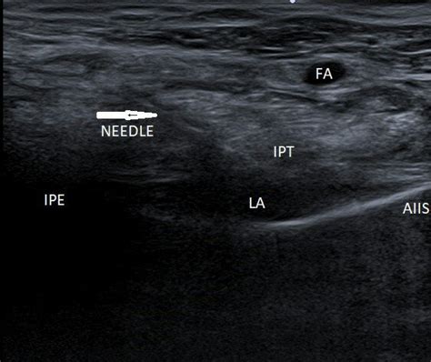 Pericapsular Nerve Group Peng Block Sonogram Image Fa Femoral Download Scientific Diagram