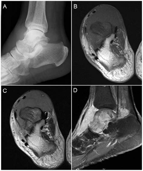 A Plain Radiograph Of The Right Ankle Lateral View Revealed No Bone