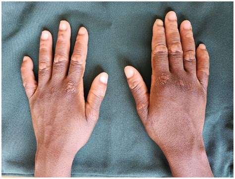 Skin Coloured Plaques Knuckle Pads Overlying The Metacarpophalangeal Download Scientific