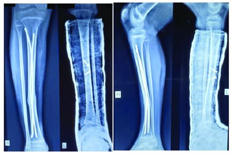 A And B Radiographs At 4 Months Showed Complete Healing Of The Right Download Scientific