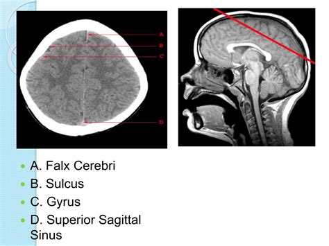 Normal Brain Ct Scan Vs Hydrocephalus Explained Ppt