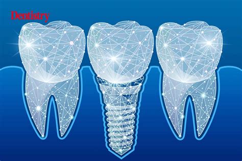 Why Should I Choose A Digital Implant Workflow Dentistry