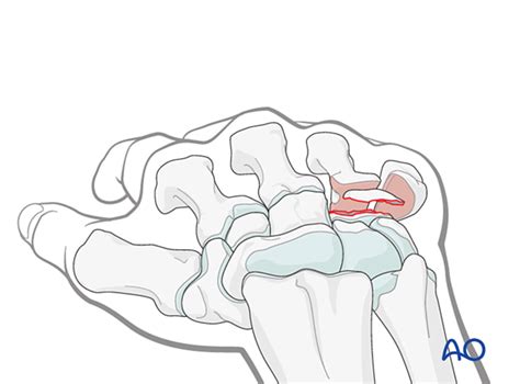 Dislocation And Fracture Dislocation Of The Carpometacarpal Joints