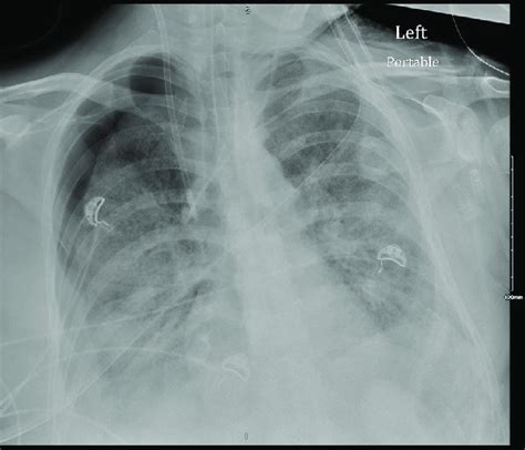 Chest Radiograph Hospital Day 32 Moderate Right Pneumothorax Which Download Scientific