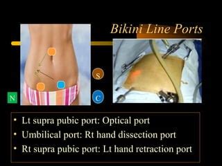 Port Position For Lap Apppendix And Ergonomics PPT