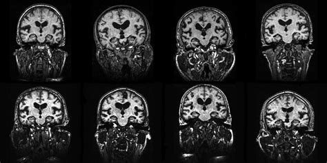 T1 Weighted Mri Images From Eight Participants With Desh Inph At Download Scientific Diagram