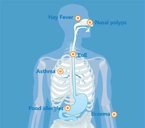 Type 2 Inflammatory Disease