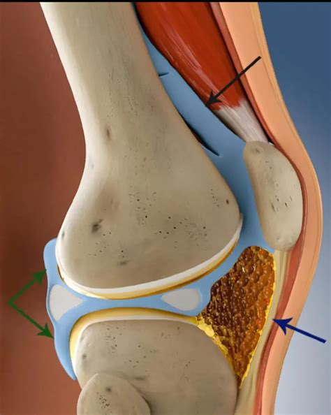 What Is Arthrofibrosis And How Is It Treated Op Dr Utku Erdem Özer