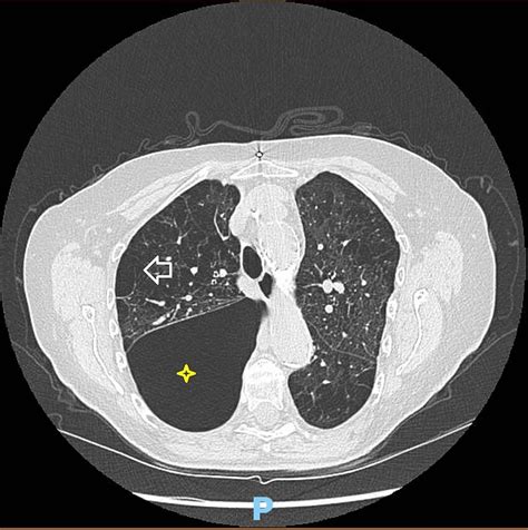 Ct Chest Showing A Pneumothorax Asterisk Measuring 119 X 89 Cm With