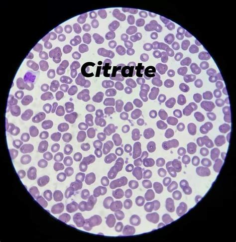 Hematology Case Study The Story Of The Platelet Clump Edta Induced