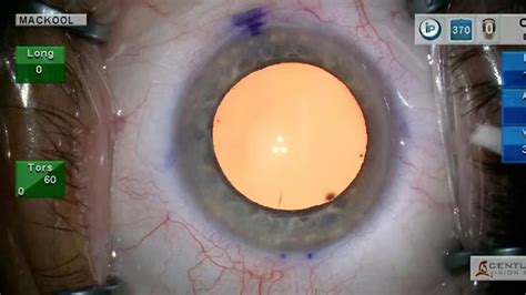 Fundamentals Episode 43 The Convex Anterior Capsule Mackool Online