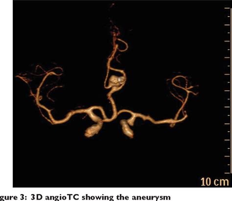 Figure 4 From Aneurysm Of Azygos Anterior Cerebral Artery Associated With Falcine Meningioma