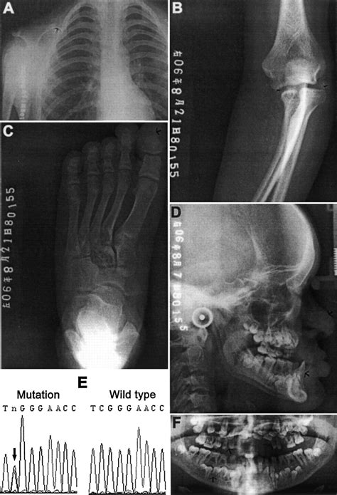 Mutations In The Runx2 Gene In Chinese Patients With Cleidocranial