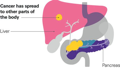 Stage 4 Pancreatic Cancer Pancreatic Cancer Uk