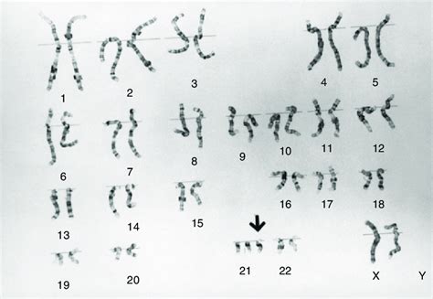 Karyotype Of Trisomy 21 Karyotype The Arrow Indicates Extra Chromosome